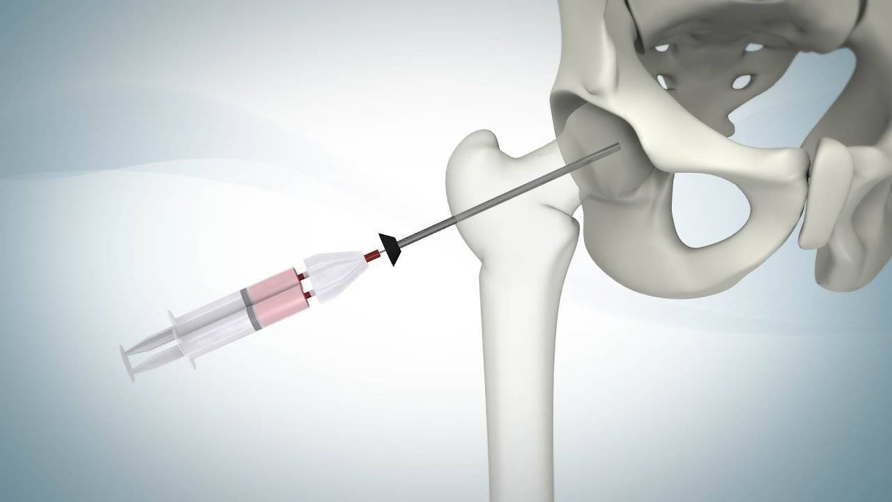 BONE MARROW ASPIRATE CONCENTRATE (BMAC)