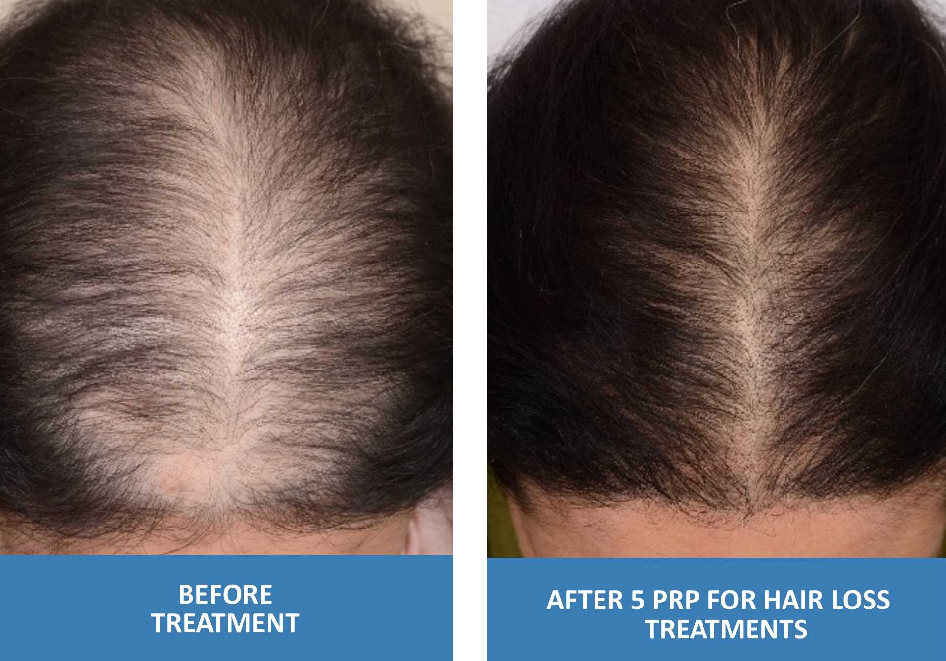 PRP Hair Treatment: A Promising Way To Restore Hairs